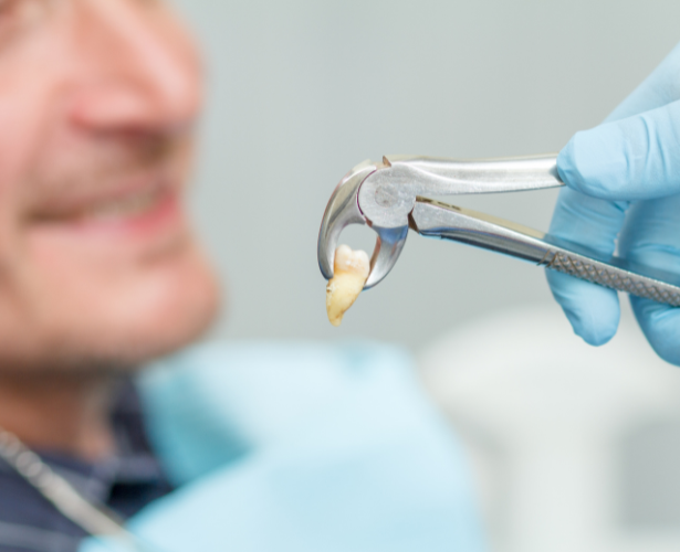 Tooth Extraction in Ottawa — Bayshore Dental Centre